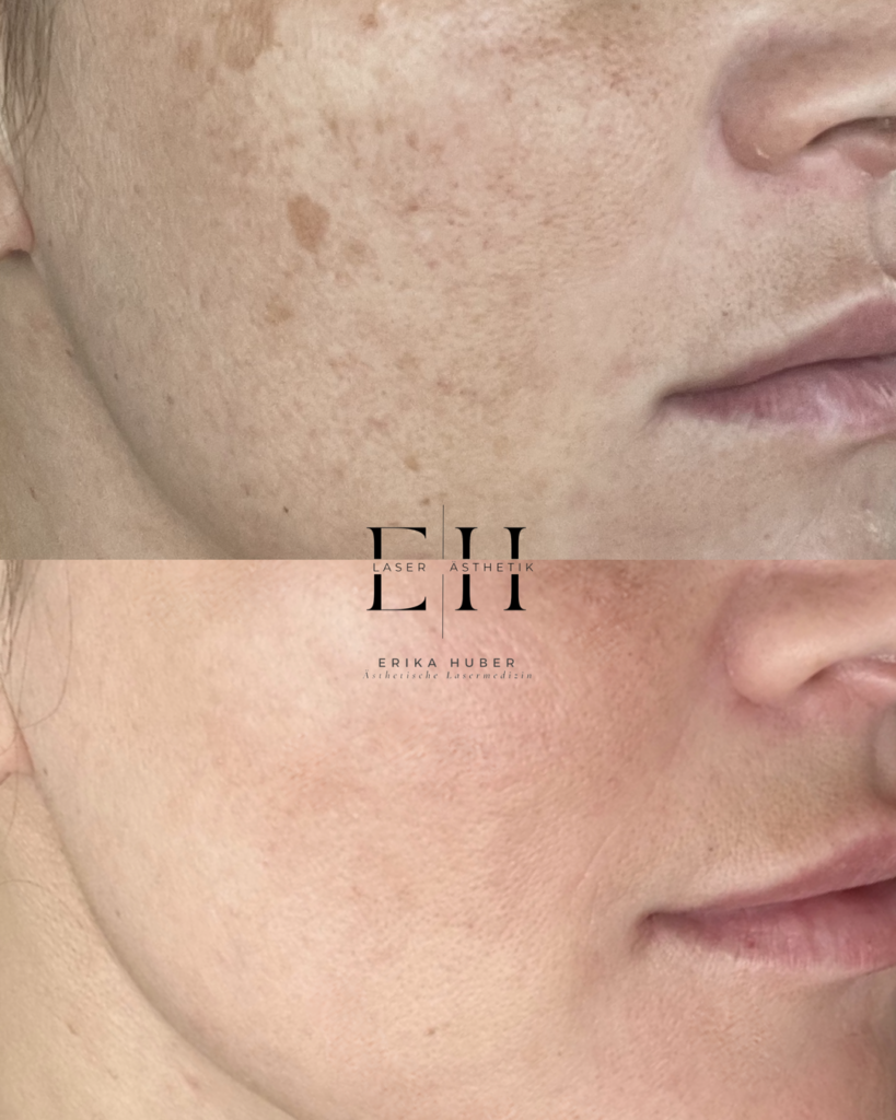 Pigmentflecken - Laser Ästhetik